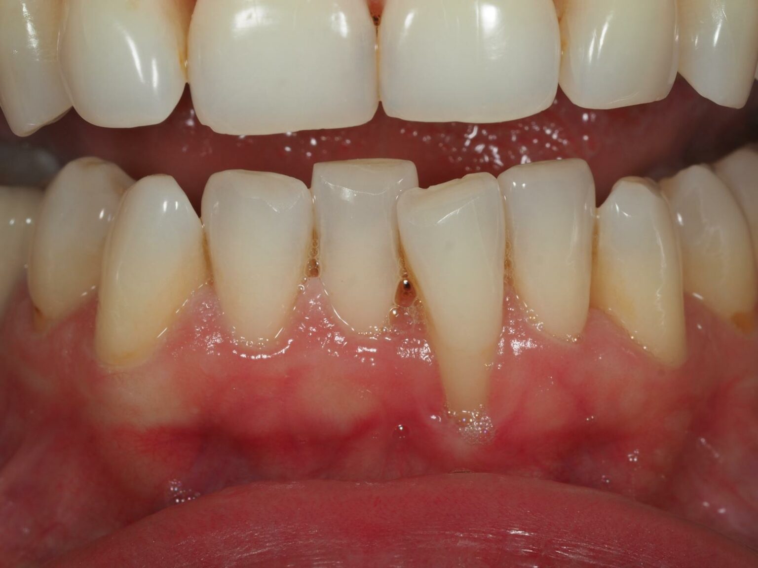 Recesión Gingival Madrid | Dr. Tomás Hernán